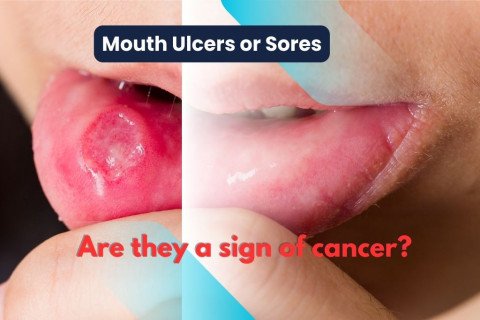 Mouth ulcers or sores . Are they a sign of cancer?